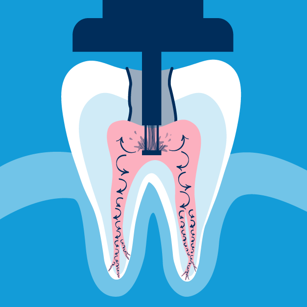 Before and After Root Canal Therapy | The GentleWave® Procedure